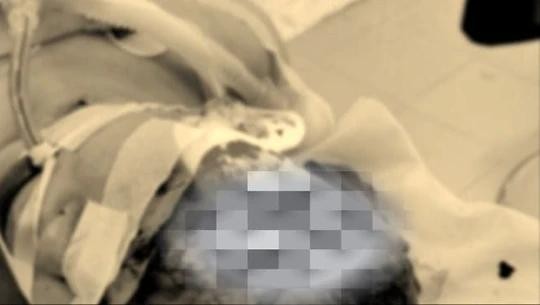 Surgeons save girl who has scalp peeled off after work accident | SGGP ...